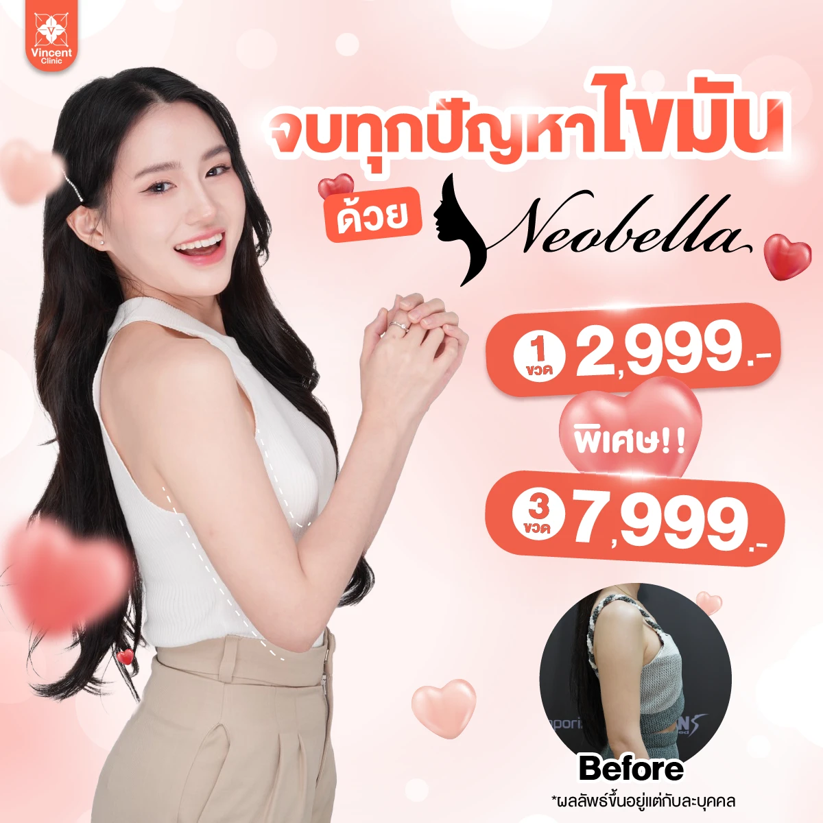 โปรโมชั่น Neobella Fat - Vincent Skin Center
