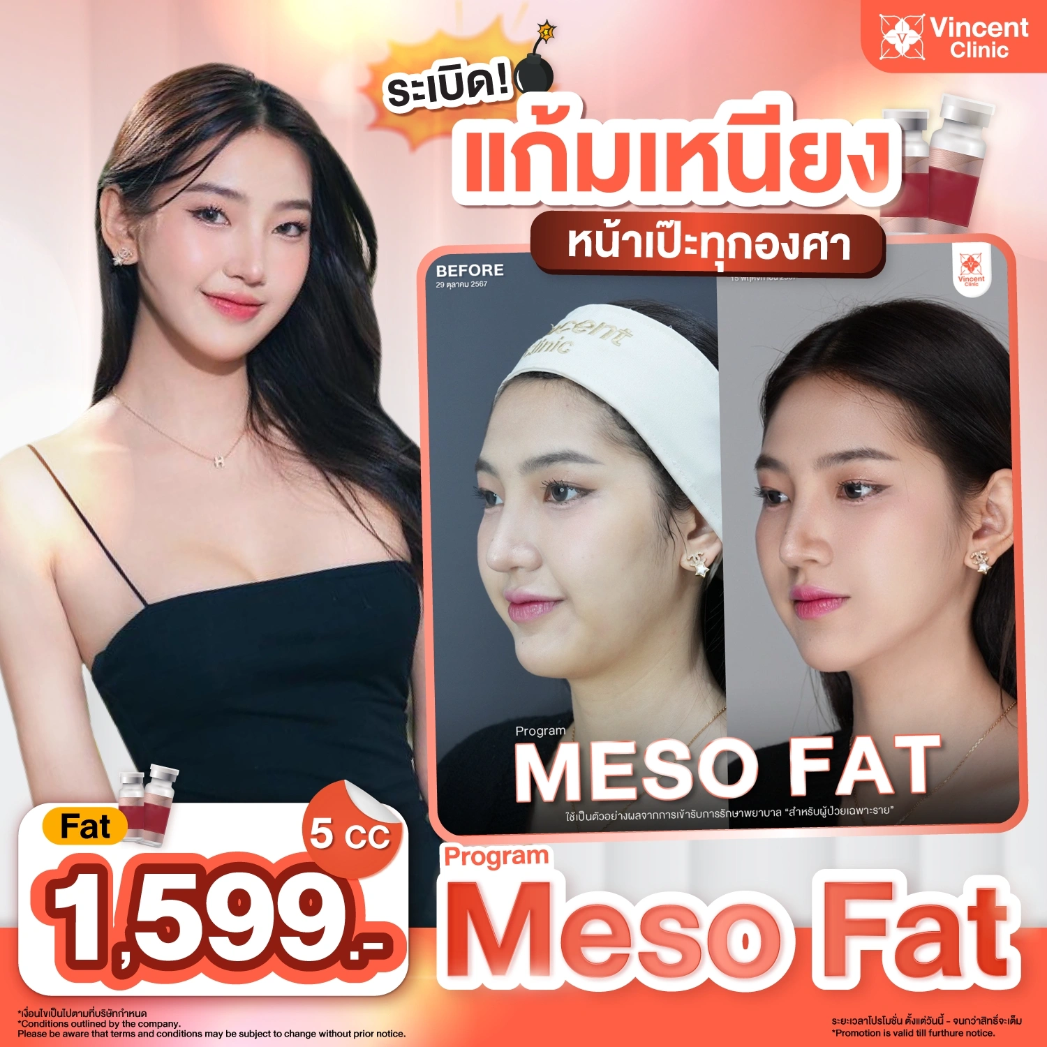 โปรโมชั่น เมโสแฟต SiSi - Vincent Clinic Bangkok Aesthetic Destinations